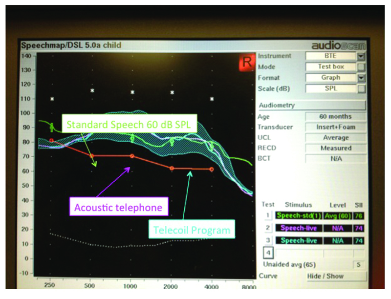 Binaural Hearing on the Telephone for Pre-school Children with Hearing Loss